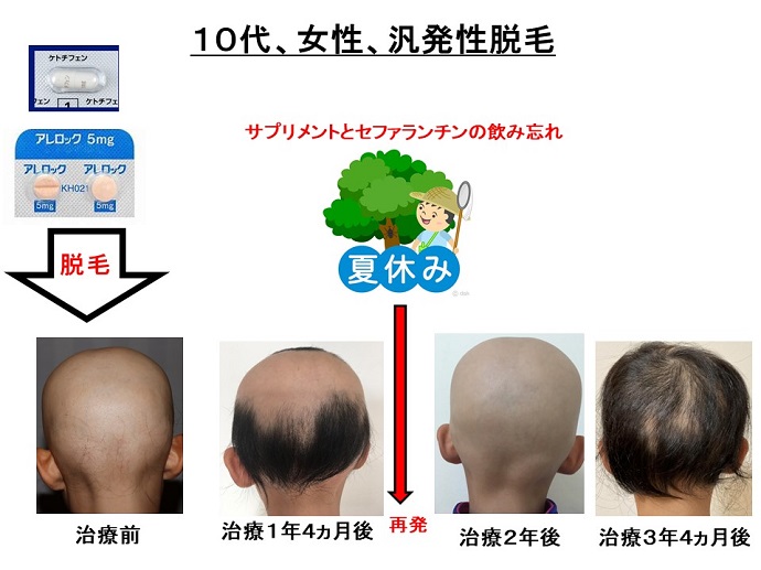 ケトチフェンとアレロックで起こった汎発性脱毛、再発を乗り越えて改善！ 患者様からの声・メディア掲載・クリニックからのお知らせ 名古屋kクリニック